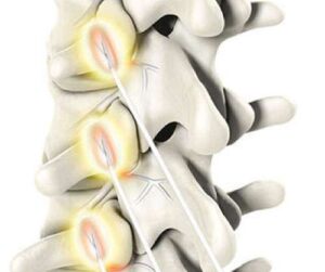 Cervical RFA Sydney | Cervical Radiofrequency Ablation